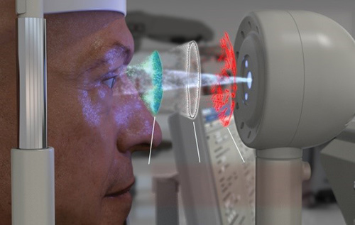 VERION（ベリオン）の導入（Alcon社） | 静岡県伊東市にある長谷川眼科